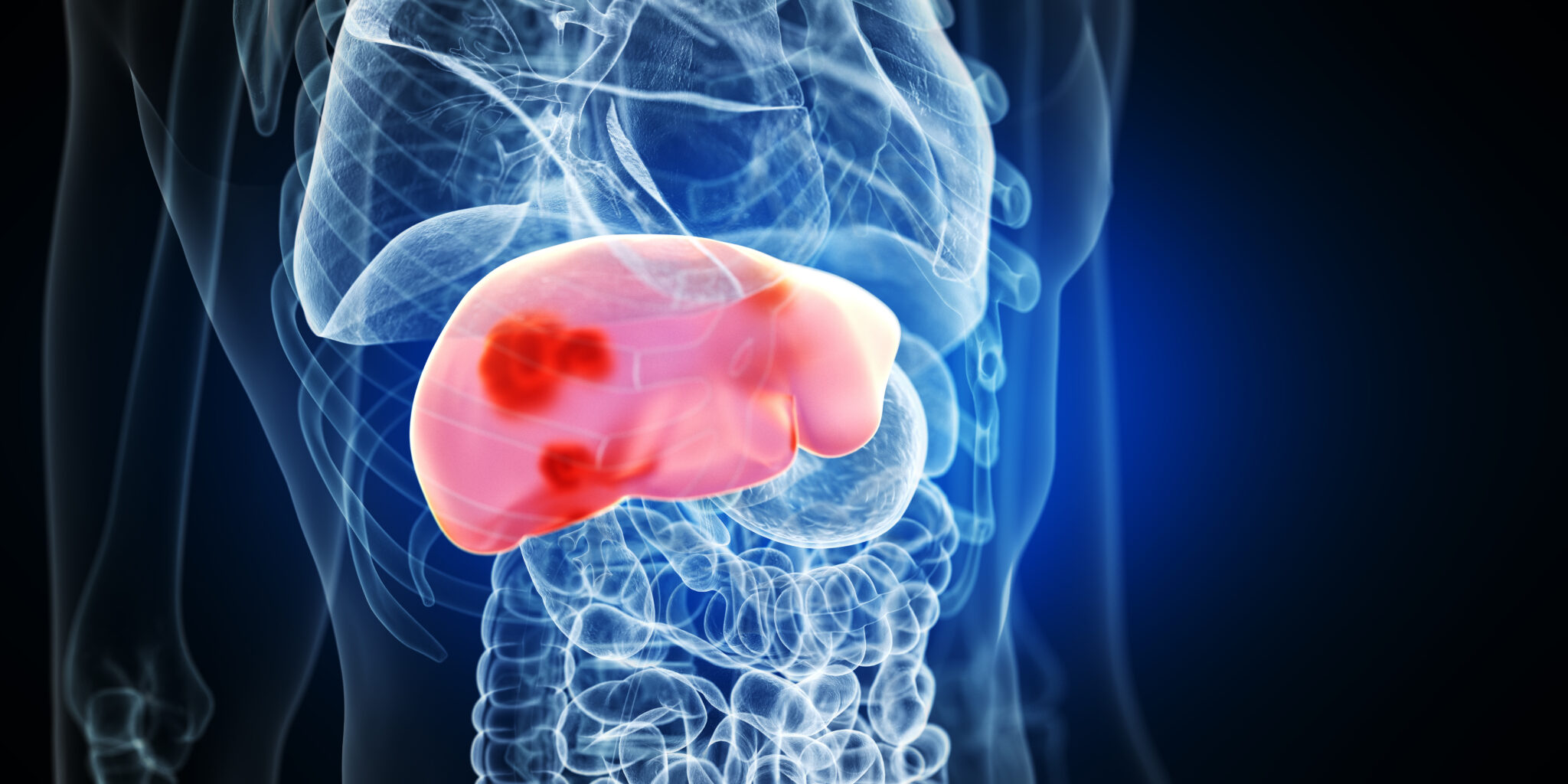 Ocaliva, Azelaprag, and the Continuing Challenge of Drug-Induced Liver ...